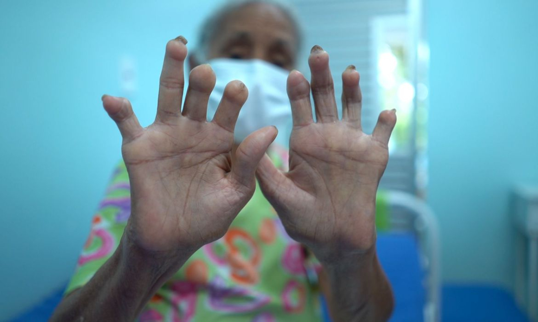 Campanha Janeiro Roxo luta contra preconceito referente à hanseníase ...